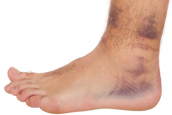 Botta, livido o ematoma sul piede: cosa devo fare? - Specialisti in ...