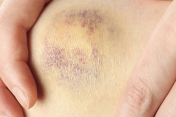 Botta, livido o ematoma sul piede: cosa devo fare? - Specialisti in ...