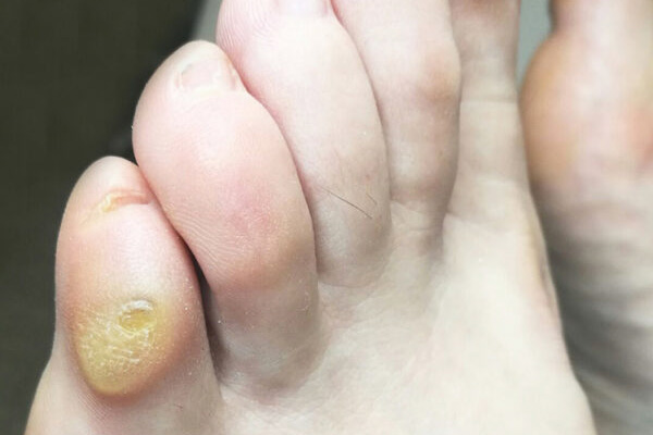 Calli ai piedi o callosità. Cosa sono, come trattarli e prevenirli ...